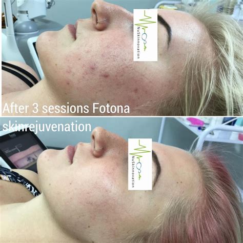 Laser Treatment For Acne Scarring Nuskinnovation Pty Ltd Laser Skin