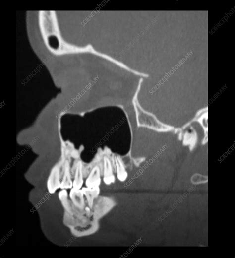 Cemento Osseous Dysplasia Ct Stock Image C039 4071 Science Photo Library