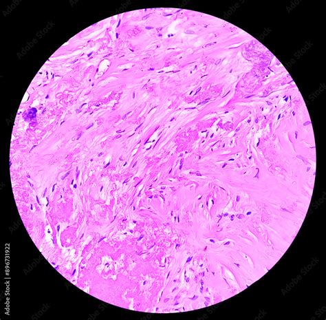 Breast Biopsy Photomicrograph Of Infiltrating Duct Cell Carcinoma Nos