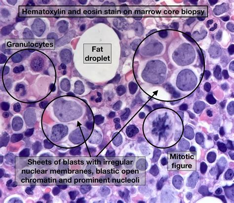 Acute Lymphoblastic Leukemia Bone Marrow Biopsy