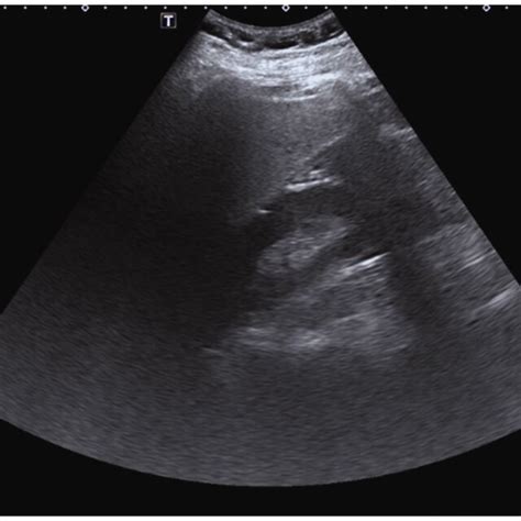 Histopathological Examination A Polymorphous Infiltrate Of