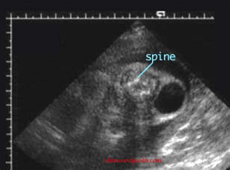 Branchial Cleft Cyst Ultrasoundpaedia