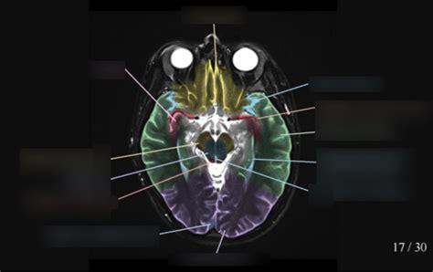 Axial Brain Mri 7 Diagram Quizlet
