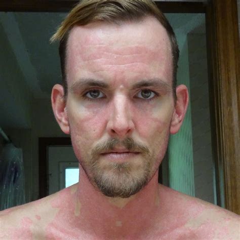 Cure Psoriasis Naturally Warrior Face A Warrior Curing Psoriasis
