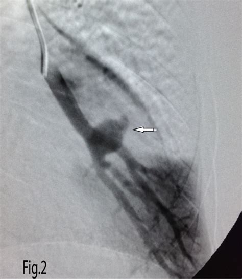 Digital Subtraction Selective Angiography Of The Left Lower Trunk