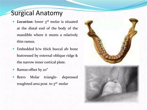 Mandibular 3rd Molar Impactions Pptx