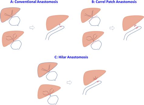 Conventional Hepaticojejunostomy Anastomosis A Versus Carrel Patch Download Scientific