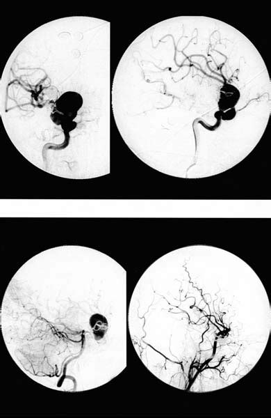 1 Multiple Paraclinoid Aneurysms Of The Internal Carotid Artery