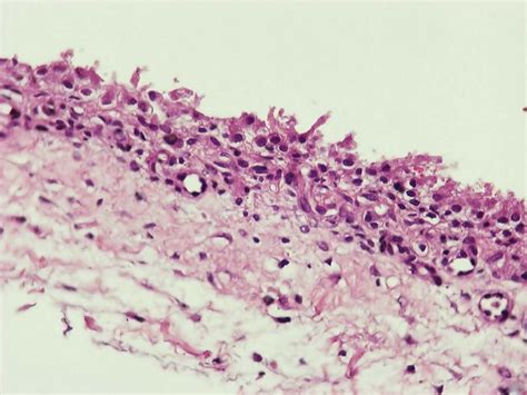 A Case Of Lumbar Hemorrhagic Synovial Cyst The Spine Journal
