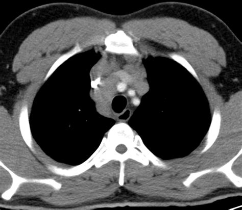 247lu Mycobacterium Avium Complex Mac Lungs