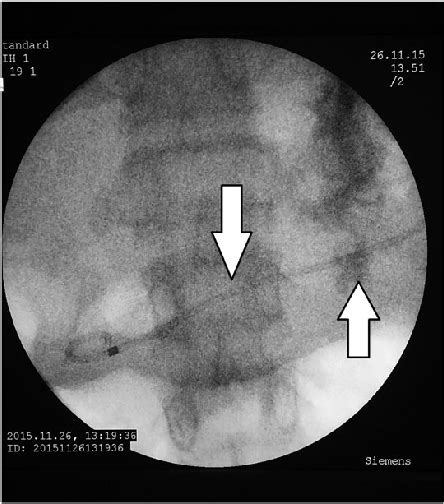 Ercp Image Showing The Successful Cannulation Of The Mpd Across The Download Scientific Diagram