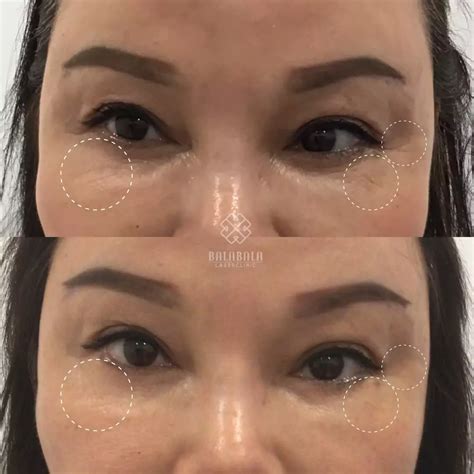 Pdo Mono Threads Balabala Laser Clinic