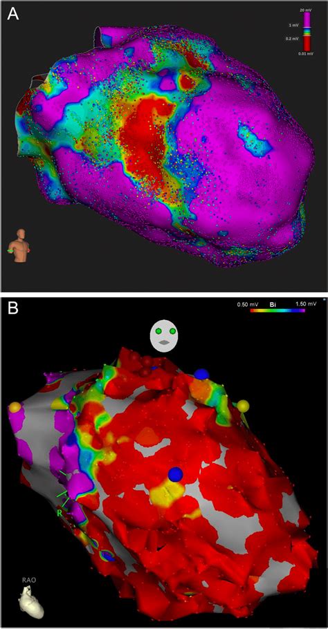 Substrate Maps Of The Left Ventricle A Ultra High Density Map A