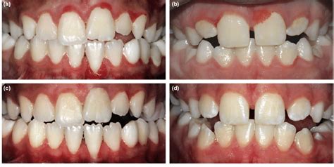 Marginal Gingiva Gingiva Anatomy Gingiva Types Carranza Marginal