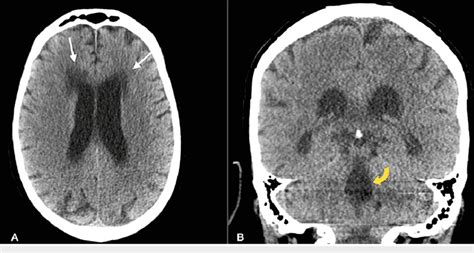 Axial CT Image A Shows New Dilatation Of Ventricular System With Download Scientific Diagram