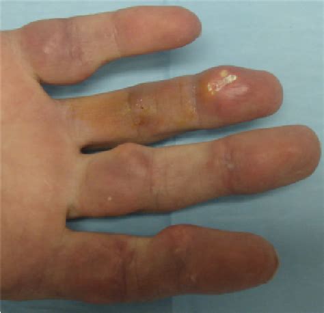 Calcinosis Cutis Of Juvenile Dermatomyositis Treated With Incision And