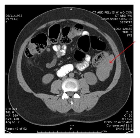 Ct Scan Of The Left Upper Abdominal Mass With Heterogeneity Adjacent