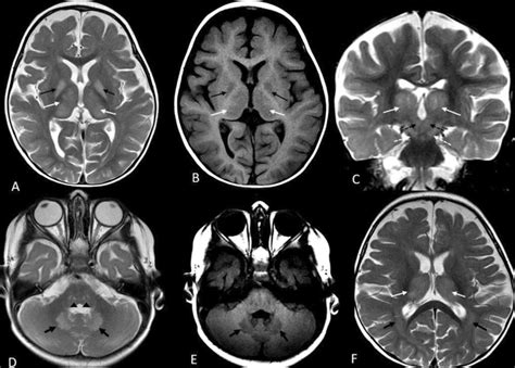 Brain Mri Demonstrated Abnormal Signal Intensity In Bilateral Thalami