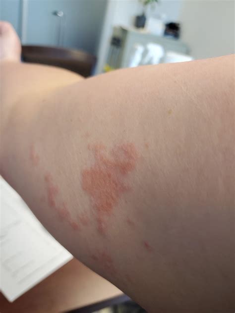 Do You Get Rashes Like This Ive Got A Rheumatologist Appointment Next Week No Diagnosis Yet