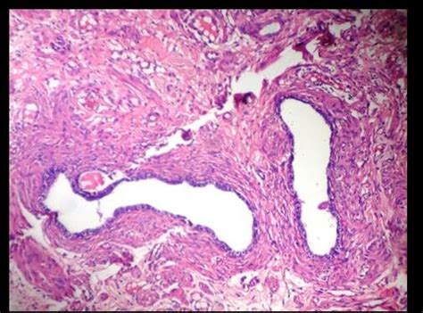Salpingitis Isthmica Nodosa Glands Surrounded By Smooth Muscle