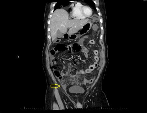 Scrotal Abscess Secondary To Perforated Appendicitis In A Middle Aged