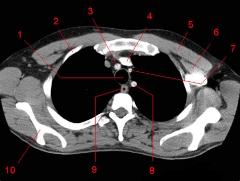 Atlas Of Ct Anatomy Of The Chest W Radiology