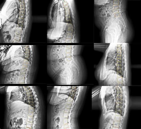 Github Limsungjoovertebrasegmentation Vertebra Lateral View X