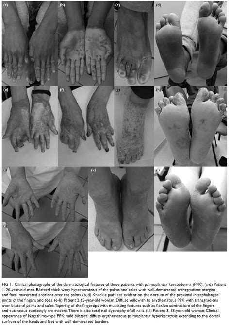 Isolated Hereditary Diffuse Palmoplantar Keratoderma In Hong Kong