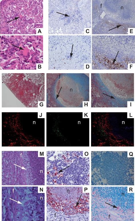 Histological Characteristics Of Human Post Primary Tb In Mtb Infected