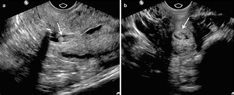 Cross Sectional Imaging Of The Uterus Radiology Key