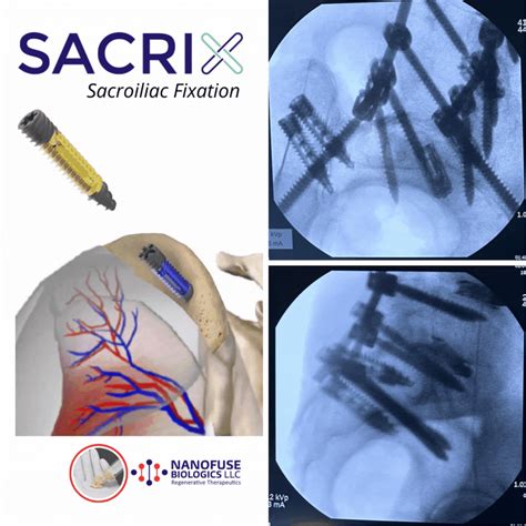 Sacrix Case Adjacent Segment Sij Disease Case Of A Patient With