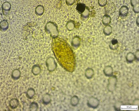Morphometric Analysis Of Schistosome Eggs Recovered From Human Urines