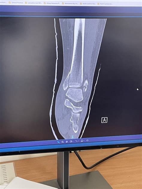 Weber C Tib Fib Fracture And Orif How Long Should I Be Raising My