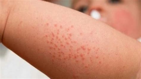 Nổi Chấm đỏ Trên Da Và Ngứa Bệnh Viện Long Xuyên