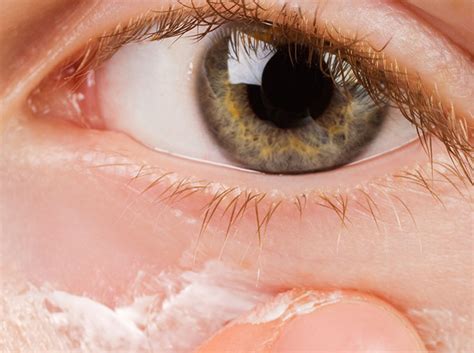 Periorbital Dermatitis Eyes