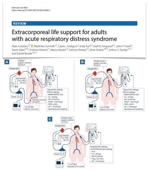 Meghan Oneill Bs Bsn Rn On Linkedin Ecls Ards Ecmo