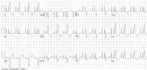Pacemaker Rhythms Normal Patterns LITFL ECG Library Diagnosis