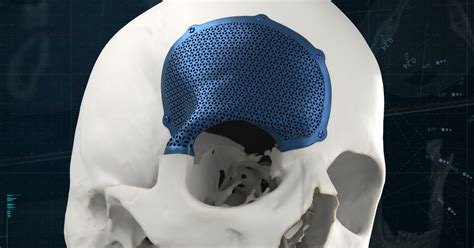 Neurosurgery 3d Printed Cranial Implants And 3d Planning