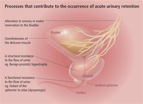 Urinary Retention Wikipedia Urinary Retention Knowledge Amboss