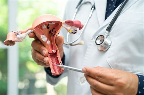 자궁 병원에서 연구 진단 및 치료를 위한 해부학 모델을 들고 있는 의사 Cervicitis에 대한 스톡 사진 및 기타 이미지