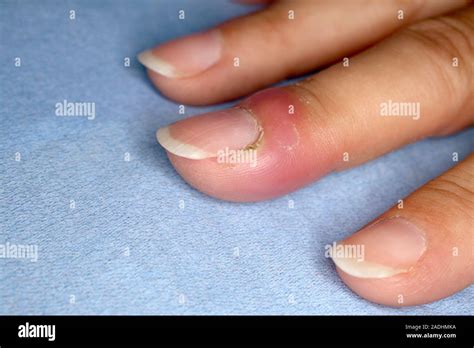 Paronychia Infection This Is The Red And Swollen Area At The Base Of