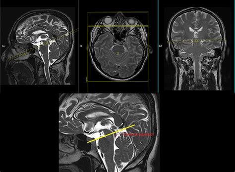 Cerebrospinal Fluid Flow Mri Csf Flow Mri Protocol And Planning