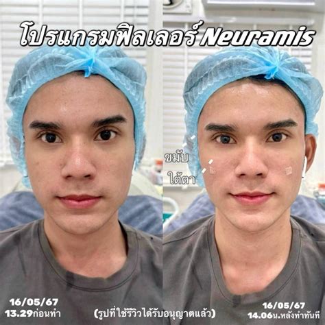 Solong Clinic ️โปรแกรมฟิลเลอร์สำหรับคุณผู้ชาย ️