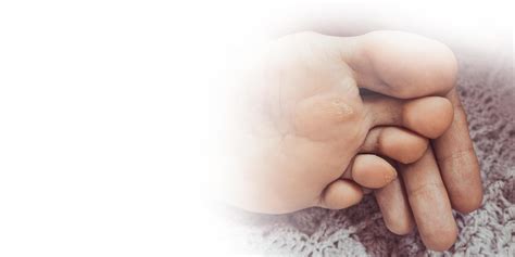 Corn And Calluses Treatment In Calgary Ab Corns And Calluses
