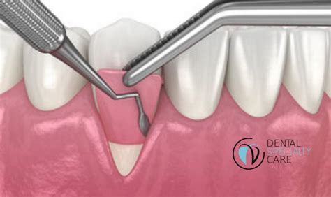 Heres Everything You Need To Know About A Gum Graft Surgery By