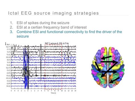 Ictal Eeg Source Imaging Pptx Brain And Nervous System Disorders