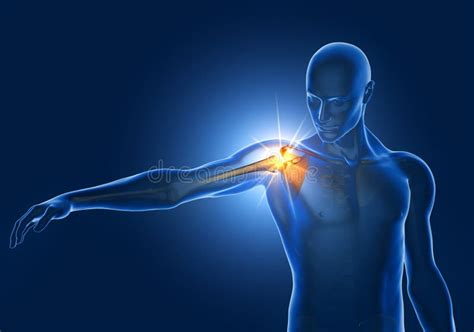 Shoulder Impingement Painfull Arc 3d Illustration Stock Illustration