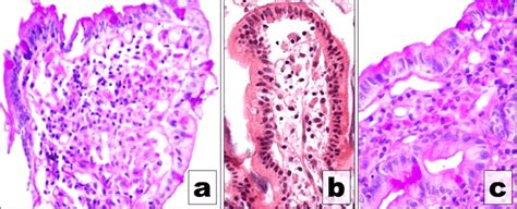 Duodenal Biopsy He Staining A ×40 B ×100 Pas Staining C