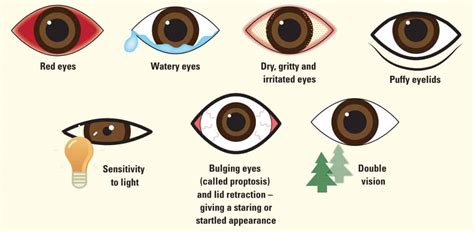 Symptoms And Treatment For Thyroid Eye Disease Narayana Nethralaya