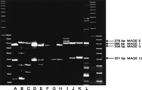 Analysis Of Representative Rt Pcr Results For Cell Lines And Breast